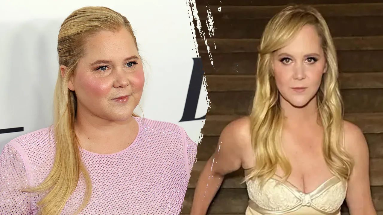 Amy Schumer's Weight Loss Linked to Cushing's Syndrome: Key Insights ...
